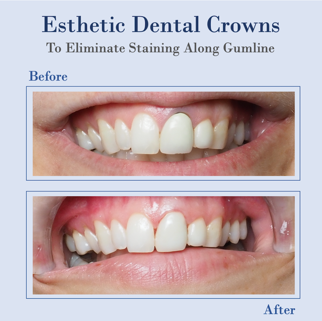 Dental Crowns Black Line