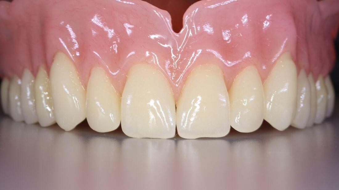 Dental Implants Winston Salem | Dental Implants Improve Dentures