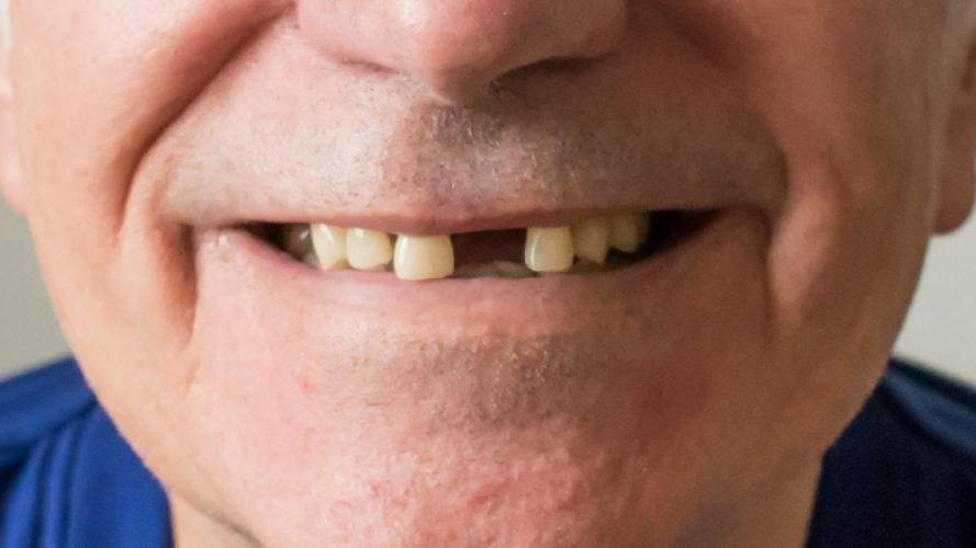 Dental Implants Winston Salem | Why do missing teeth cause problems?
